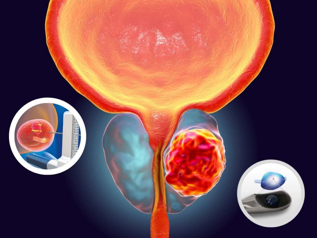 ¿Qué pacientes son candidatos ideales para la terapia focal del cáncer ...